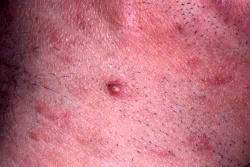 Tâches Rubis | Laser Versailles